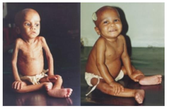 Modern Malnutrition – Effects on Skin